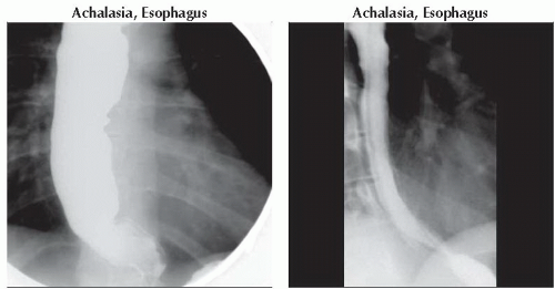 Esophageal Dysmotility
