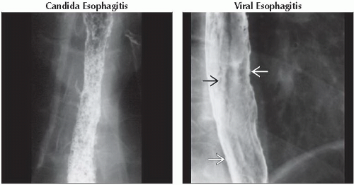 DA3-DB1-Mucosal_Nodularity_Esophagus-FFU3.gif | Abdominal Key