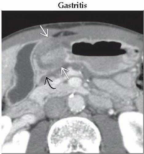 DA4-DB1-Gastric_Antral_Narrowing-FFU2.gif | Abdominal Key