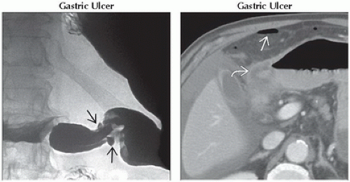 DA4-DB1-Gastric_Antral_Narrowing-FFU3.gif | Abdominal Key