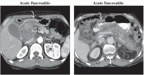DA4-DB1-Gastric_Antral_Narrowing-FFU5.gif | Abdominal Key