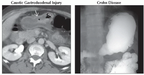 DA4-DB1-Gastric_Antral_Narrowing-FFU8.gif | Abdominal Key