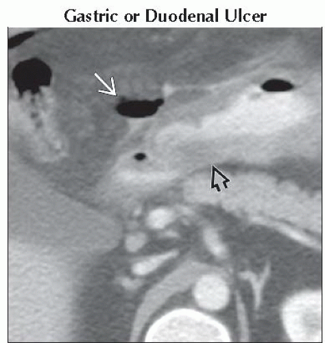 DA4-DB1-Gastric_Dilation_or_Outlet_Obstruction-FFU2.gif | Abdominal Key