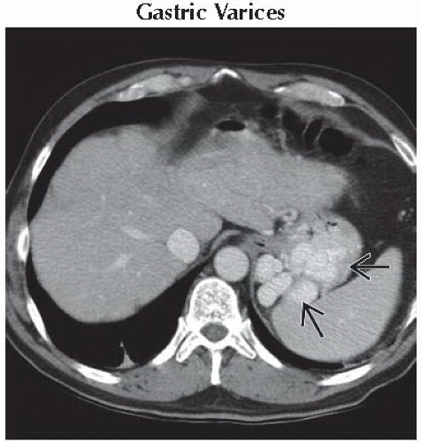 DA4-DB1-Intramural_Mass_Stomach-FFU1.gif | Abdominal Key