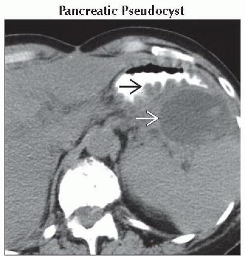 DA4-DB1-Intramural_Mass_Stomach-FFU2.gif | Abdominal Key