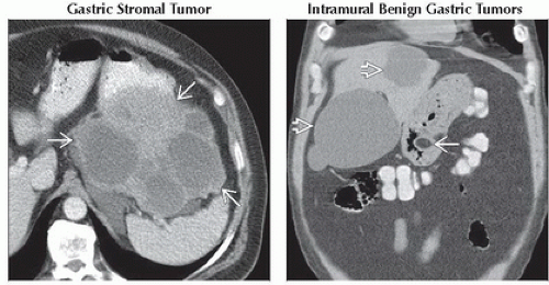 DA4-DB1-Intramural_Mass_Stomach-FFU3.gif | Abdominal Key