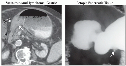 DA4-DB1-Intramural_Mass_Stomach-FFU5.gif | Abdominal Key