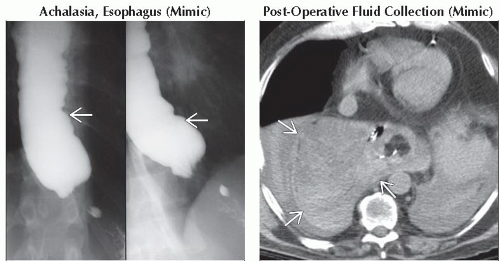 DA4-DB1-Intrathoracic_Stomach-FFU4.gif | Abdominal Key