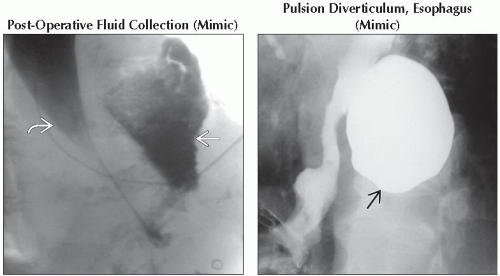 DA4-DB1-Intrathoracic_Stomach-FFU5.gif | Abdominal Key