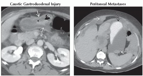 DA4-DB1-Linitis_Plastica_Limited_Distensibility-FFU7.gif | Abdominal Key