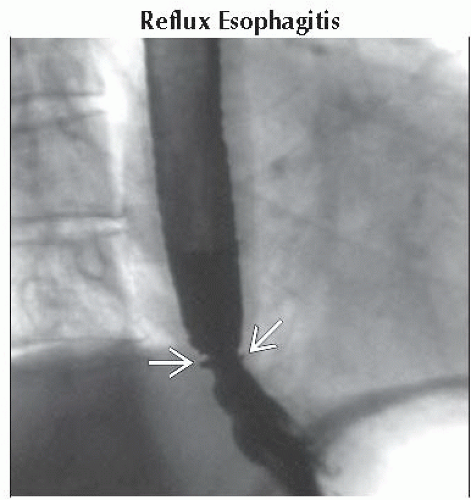 DA4-DB2-Epigastric_Pain-FFU1.gif | Abdominal Key