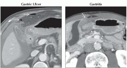 DA4-DB2-Epigastric_Pain-FFU3.gif | Abdominal Key