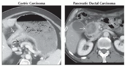 DA4-DB2-Epigastric_Pain-FFU8.gif | Abdominal Key