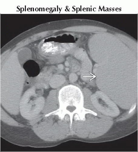 DA4-DB2-Left_Upper_Quadrant_Mass-FFU1.gif | Abdominal Key