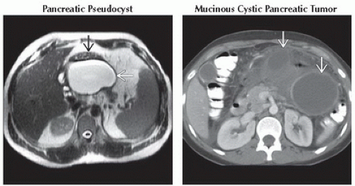 DA4-DB2-Left_Upper_Quadrant_Mass-FFU5.gif | Abdominal Key