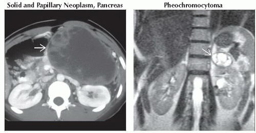 DA4-DB2-Left_Upper_Quadrant_Mass-FFU6.gif | Abdominal Key