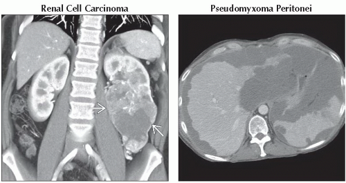 DA4-DB2-Left_Upper_Quadrant_Mass-FFU8.gif | Abdominal Key