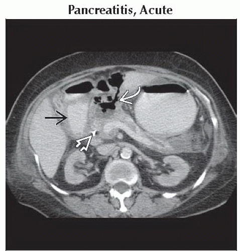DA5-DB1-Dilated_Duodenum-FFU2.gif | Abdominal Key