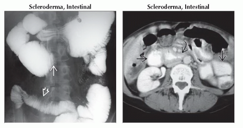 DA5-DB1-Dilated_Duodenum-FFU4.gif | Abdominal Key