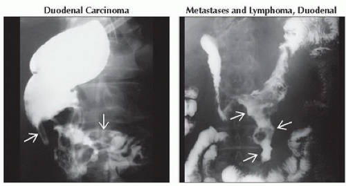 DA5-DB1-Duodenal_Filling_Defects-FFU5.gif | Abdominal Key