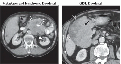 DA5-DB1-Duodenal_Filling_Defects-FFU6.gif | Abdominal Key