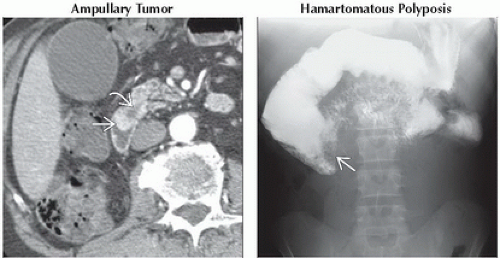 DA5-DB1-Duodenal_Filling_Defects-FFU7.gif | Abdominal Key