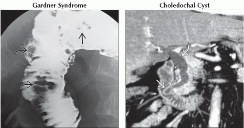 DA5-DB1-Duodenal_Filling_Defects-FFU8.gif | Abdominal Key