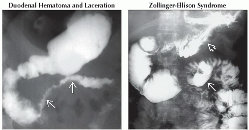 DA5-DB1-Thickened_Duodenal_Folds-FFU4.gif | Abdominal Key