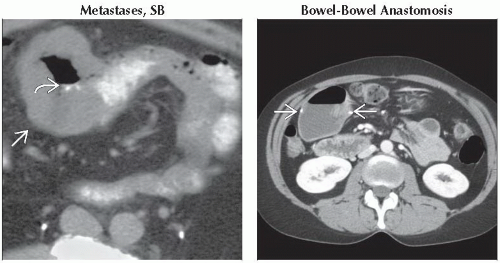 DA6-DB1-Aneurysmal_Dilation_of_Small_Bowel_Lumen-FFU3.gif | Abdominal Key