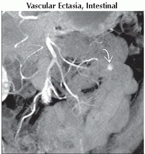 DA6-DB2-Occult_GI_Bleeding-FFU2.gif | Abdominal Key