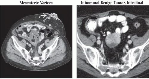 DA6-DB2-Occult_GI_Bleeding-FFU5.gif | Abdominal Key