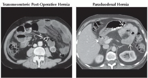 DA6-DB2-Small_Bowel_Obstruction-FFU10.gif | Abdominal Key