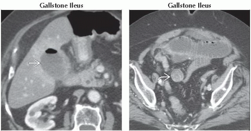 DA6-DB2-Small_Bowel_Obstruction-FFU12.gif | Abdominal Key