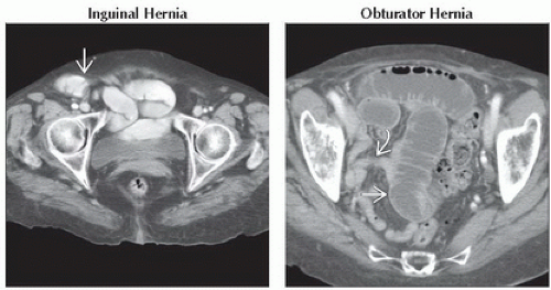 DA6-DB2-Small_Bowel_Obstruction-FFU4.gif | Abdominal Key