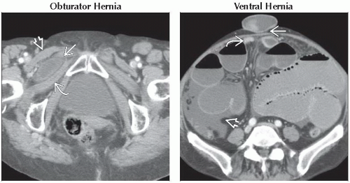 DA6-DB2-Small_Bowel_Obstruction-FFU5.gif | Abdominal Key