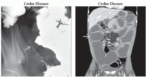 DA6-DB2-Small_Bowel_Obstruction-FFU6.gif | Abdominal Key