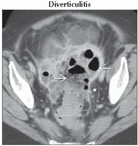 DA7-DB1-Colonic_Fistula-FFU1.gif | Abdominal Key