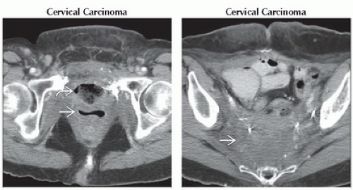 DA7-DB1-Colonic_Fistula-FFU3.gif | Abdominal Key