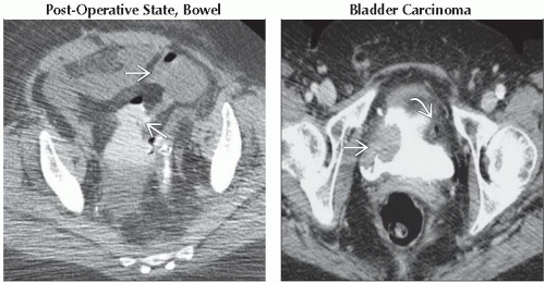 DA7-DB1-Colonic_Fistula-FFU5.gif | Abdominal Key