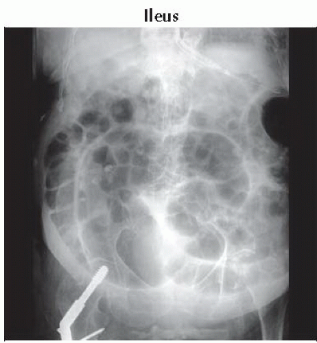 DA7-DB1-Colonic_Ileus_or_Dilation-FFU1.gif | Abdominal Key