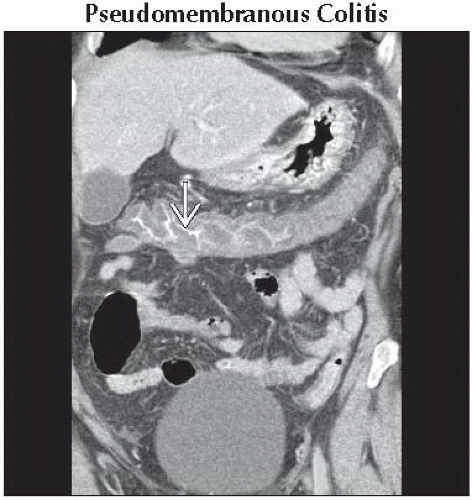 DA7-DB1-Colonic_Thumbprinting-FFU1.gif | Abdominal Key