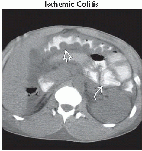 DA7-DB1-Colonic_Thumbprinting-FFU2.gif | Abdominal Key