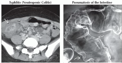 DA7-DB1-Colonic_Thumbprinting-FFU5.gif | Abdominal Key