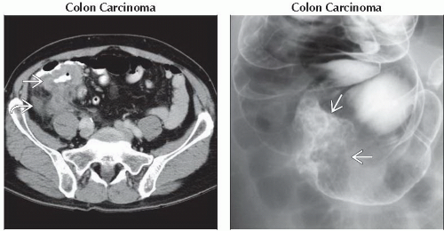 DA7-DB1-Mass_or_Inflammation_of_Ileocecal_Area-FFU7.gif | Abdominal Key