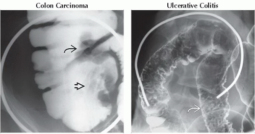 DA7-DB1-Multiple_Colonic_Filling_Defects-FFU3.gif | Abdominal Key