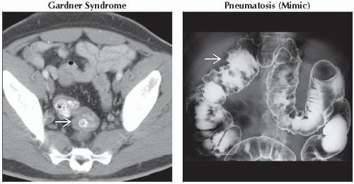 DA7-DB1-Multiple_Colonic_Filling_Defects-FFU5.gif | Abdominal Key
