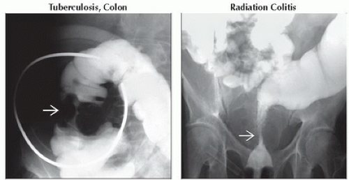 DA7-DB1-Segmental_Colonic_Narrowing-FFU8.gif | Abdominal Key