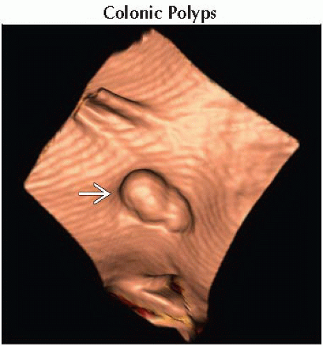DA7-DB1-Solitary_Colonic_Filling_Defect-FFU2.gif | Abdominal Key