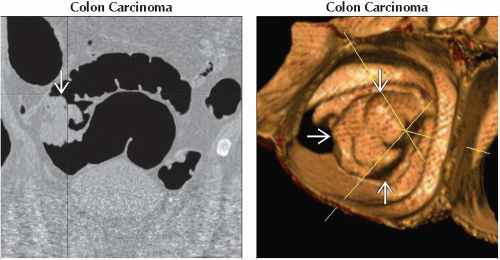DA7-DB1-Solitary_Colonic_Filling_Defect-FFU3.gif | Abdominal Key