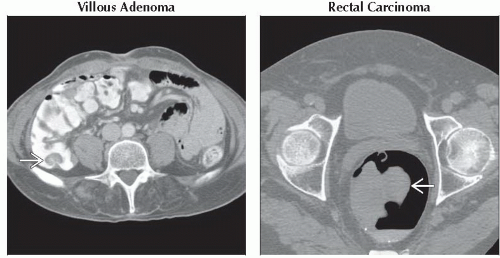 DA7-DB1-Solitary_Colonic_Filling_Defect-FFU4.gif | Abdominal Key
